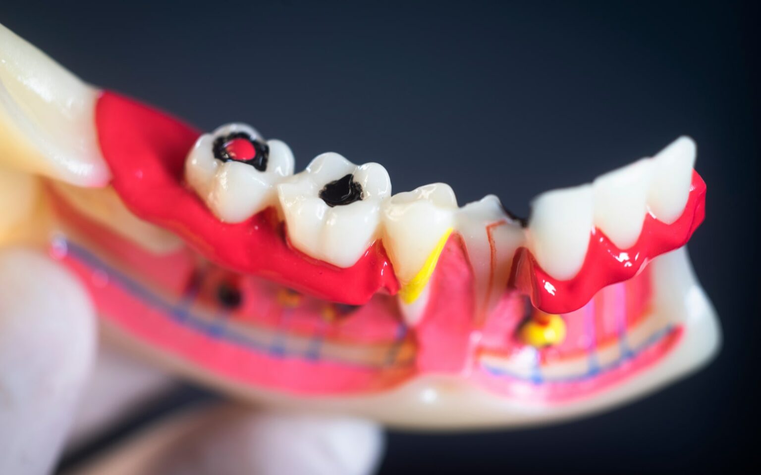 Finding and Treating The Trickiest Root Canal, The MB2 | Irvine Endodontics